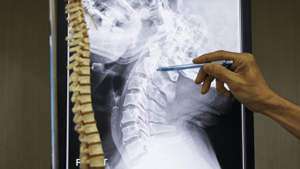 Cervical Disc Disease - First State Spine