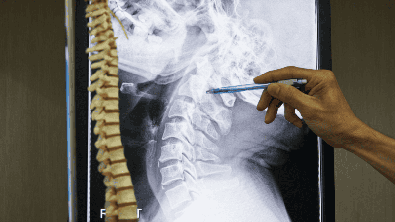 Cervical Spine Archives - First State Spine